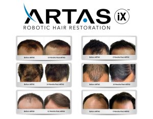 Artas IX Robotic Fue - Abrams Hair Restoration – Dr. Jack Abrams Hair ...