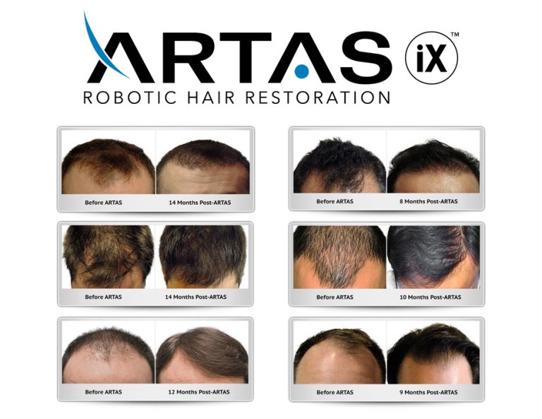 Artas IX Robotic Fue - Abrams Hair Restoration – Dr. Jack Abrams Hair ...